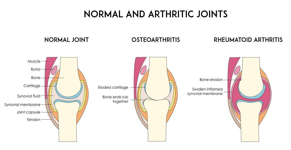 What is Arthritis? Helpful Homeopathic Medicines for it - BJain
