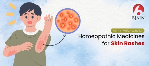 From Irritation to Relief: Homeopathic Remedies for Skin Rashes